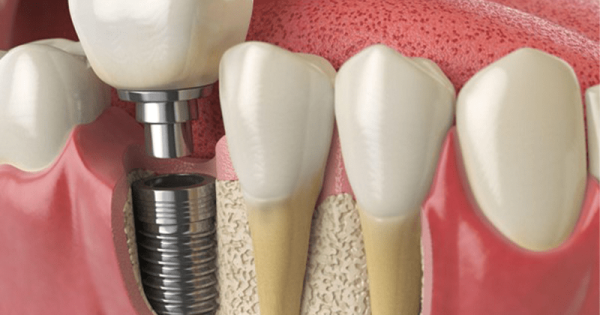 Implante dentário de A a Z: o que você precisa saber